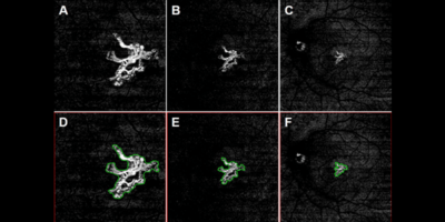 Comparison of Neovascular Lesion Area Measurements From Different Swept ...